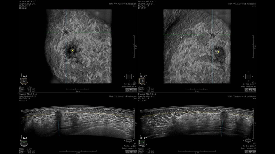 Tailored Breast Care | GE Healthcare